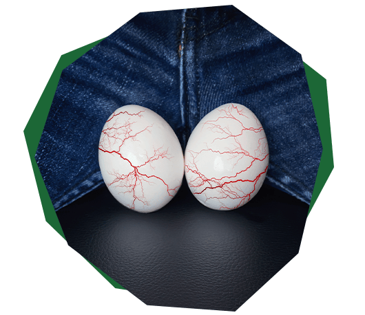 Varicocele Treatment Without Surgery Dr Health